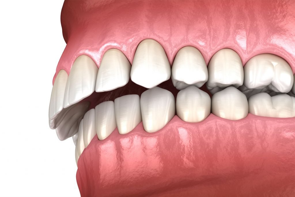 Overbite Braces | Fix Overbite
